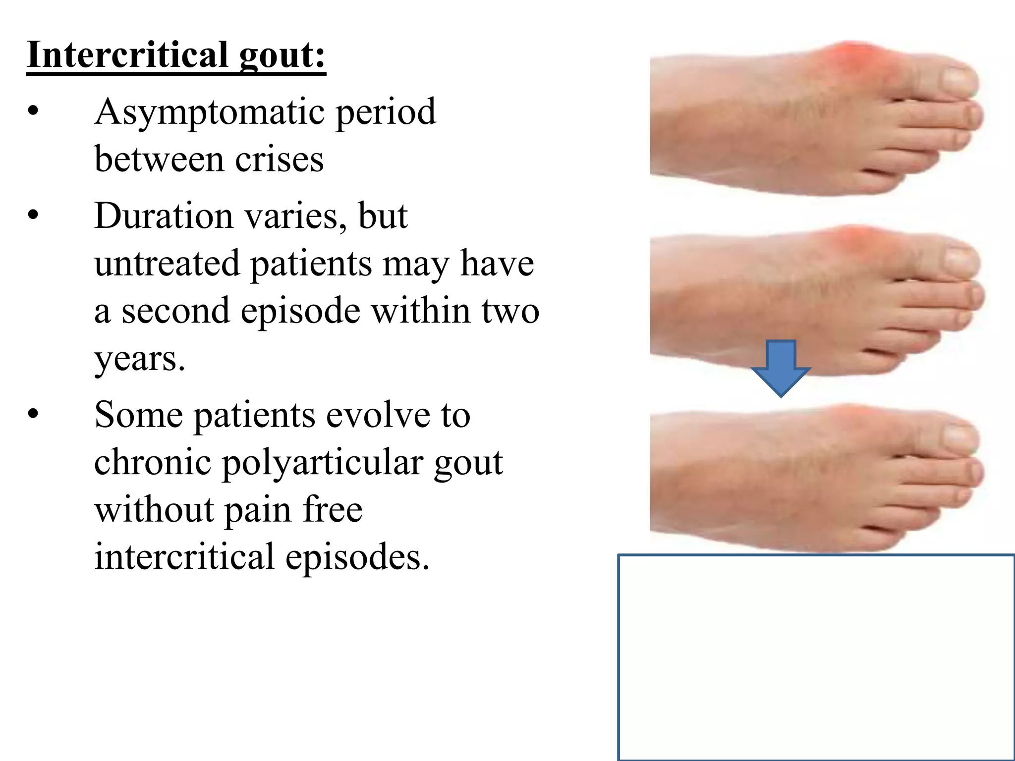 Gouty arthritis | PPTX