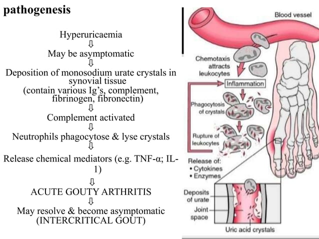 Gouty arthritis | PPTX | Digestive Disorders | Diseases and Conditions