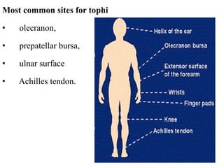 Tophus Most Common Location