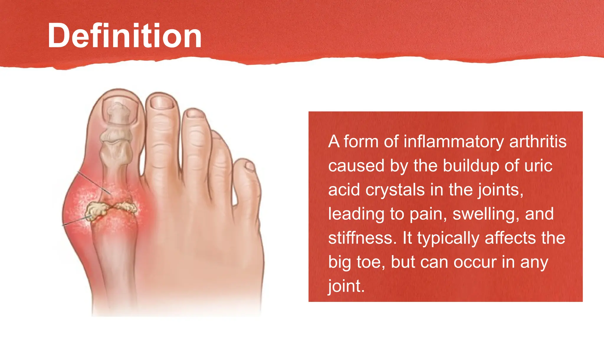 Gouty Arthritis, or Gout, Inflammatory arthritis PPT | PPTX