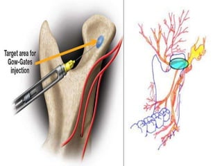 Gow gates & vazirani akinosi technique of nerve | PPTX