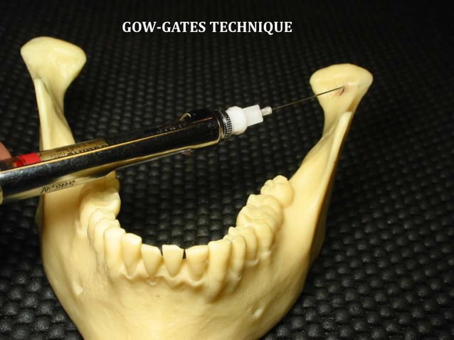 Gow gates & vazirani akinosi technique of nerve | PPTX