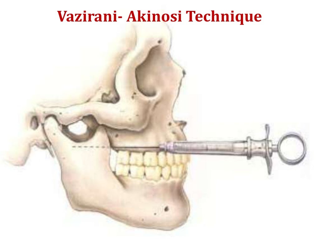 Gow gates & vazirani akinosi technique of nerve