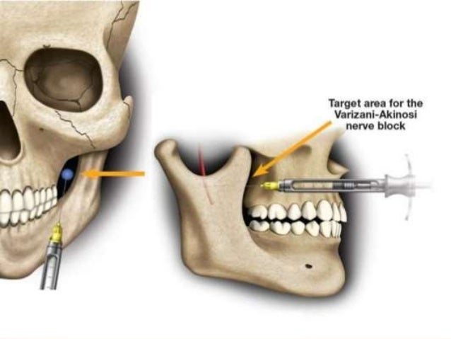 Gow gates & vazirani akinosi technique of nerve