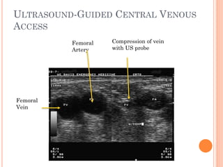 HAEMODYNAMIC MONITORING – CVP, PAC AND IBP | PPTX