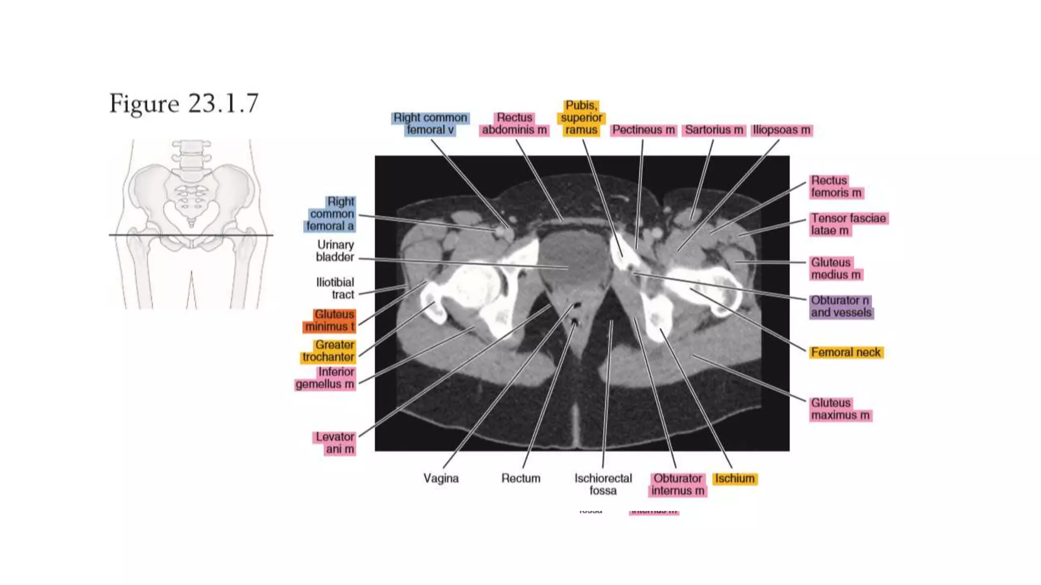 Gowthams 2nd Ca Cervix Anatomy Ppt