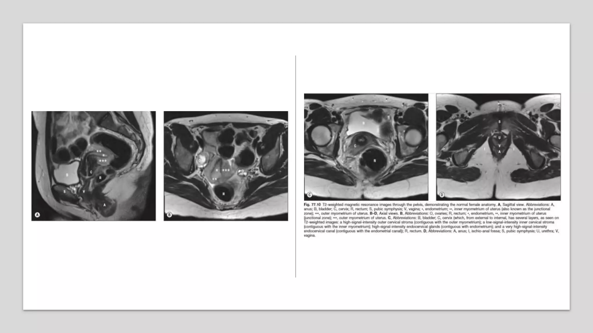 Gowtham's 2nd ca cervix anatomy | PPT