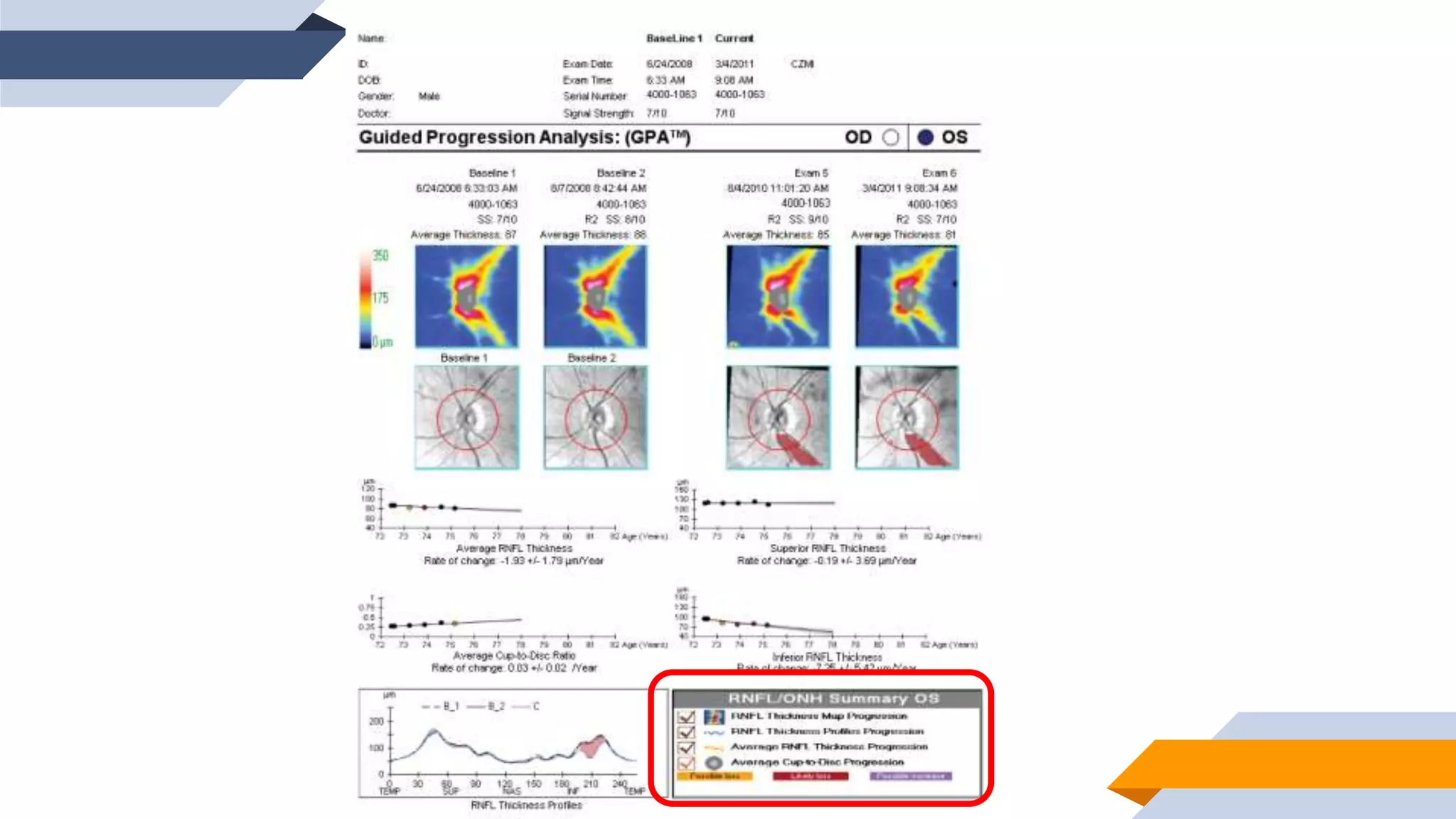 Glaucoma Guided Progression Analysis - Dr Shylesh Dabke | PPTX