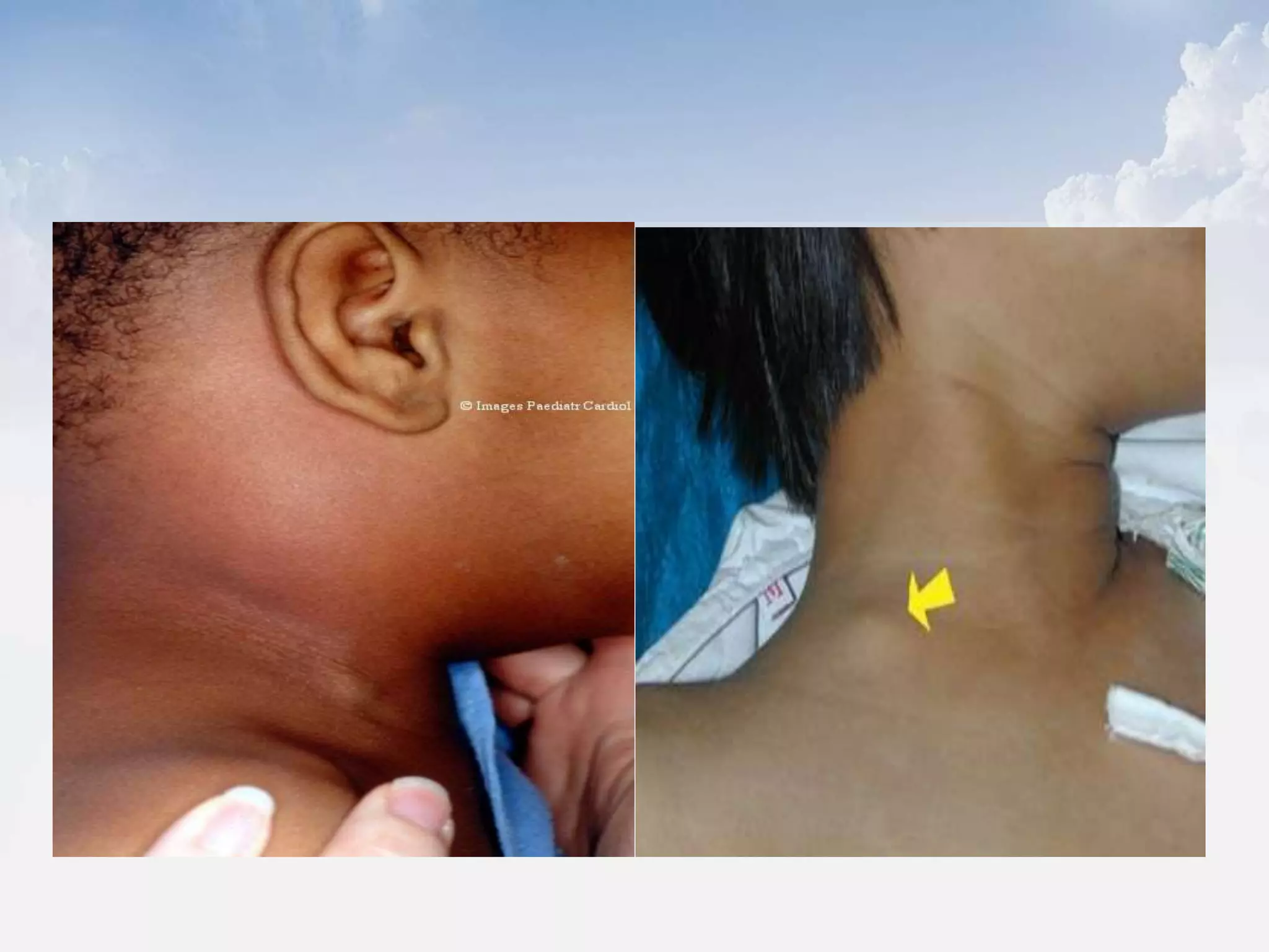 GPE in paediatrics | PPTX