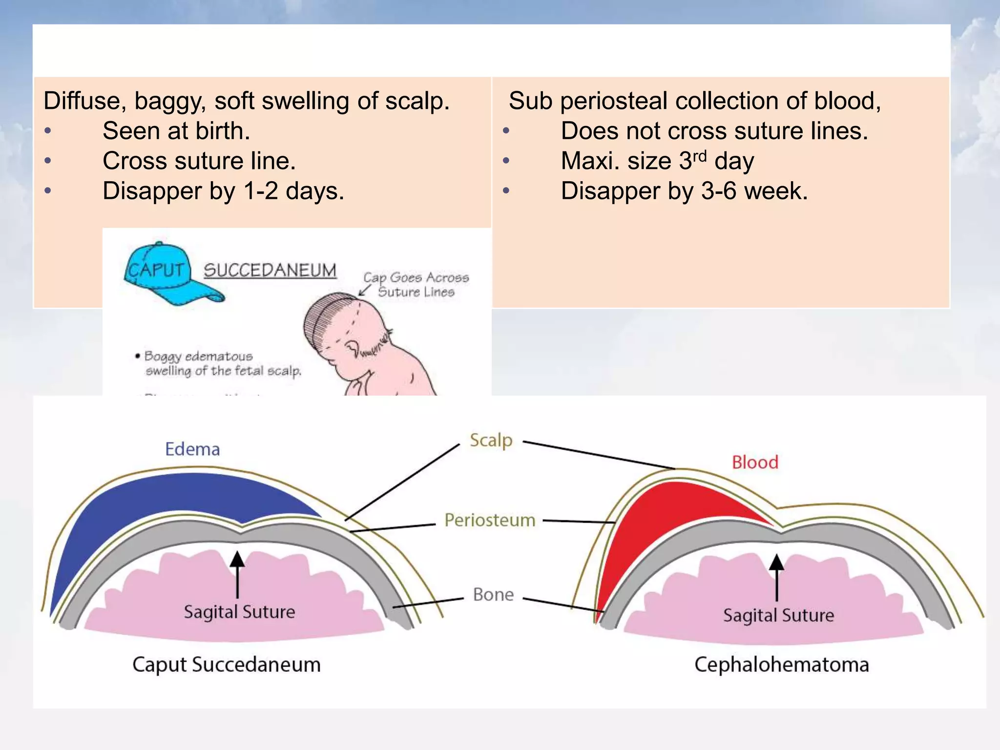GPE in paediatrics | PPTX