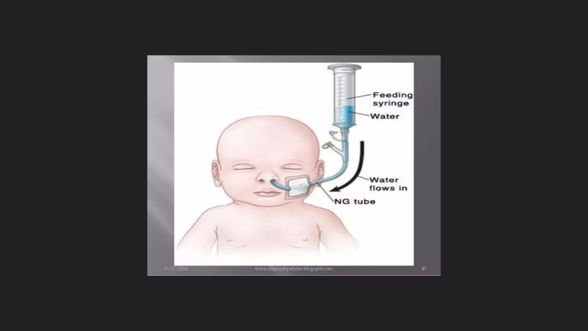 Nasogastric tube feeding | PPTX