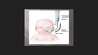 Nasogastric tube feeding | PPTX