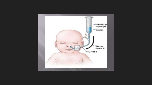 Nasogastric tube feeding | PPTX