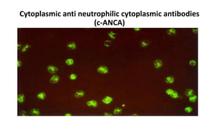 Goodpasture Syndrome | PPTX