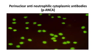 Goodpasture Syndrome | PPTX