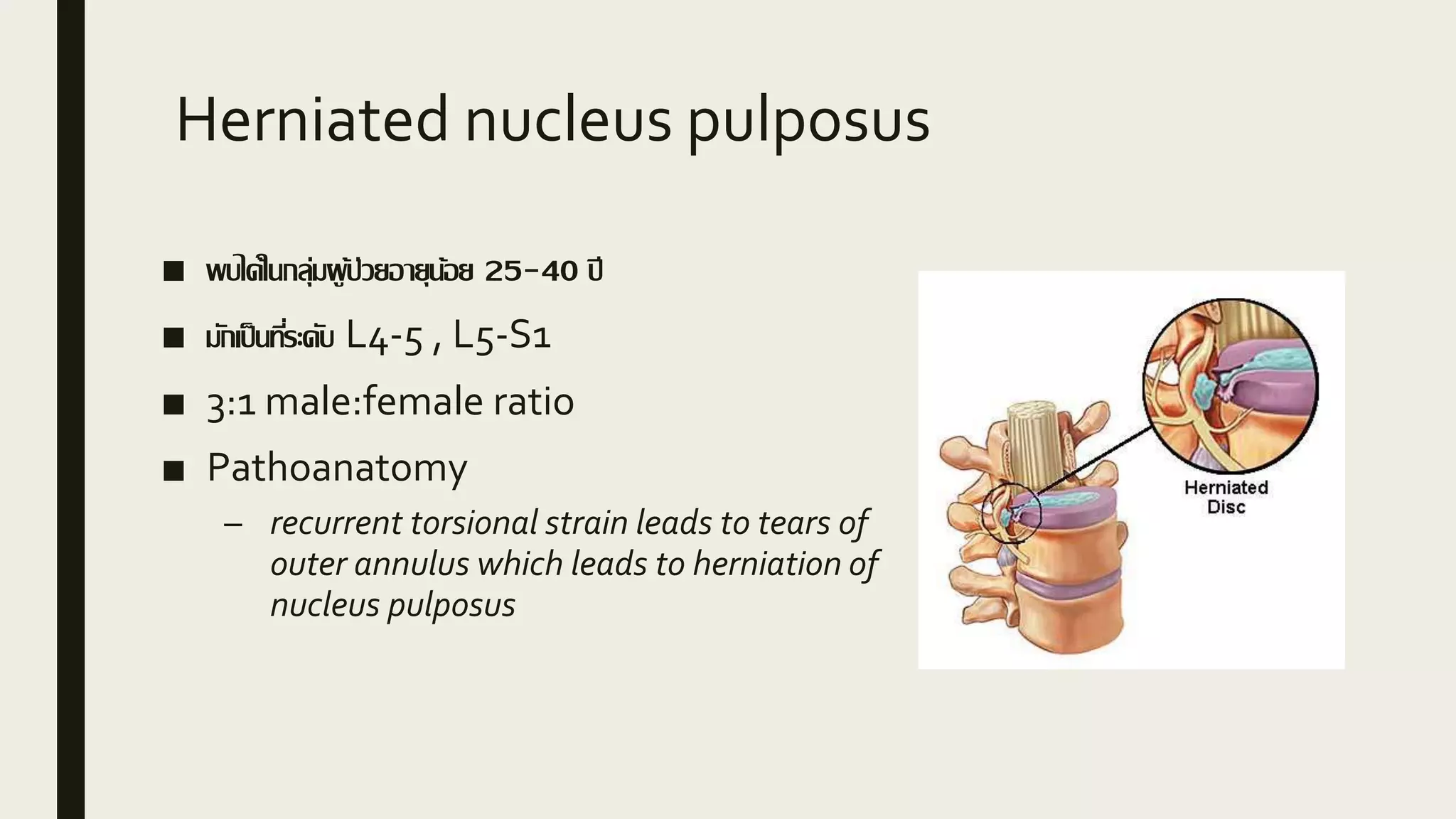 Herniated nucleus pulposus | PPTX