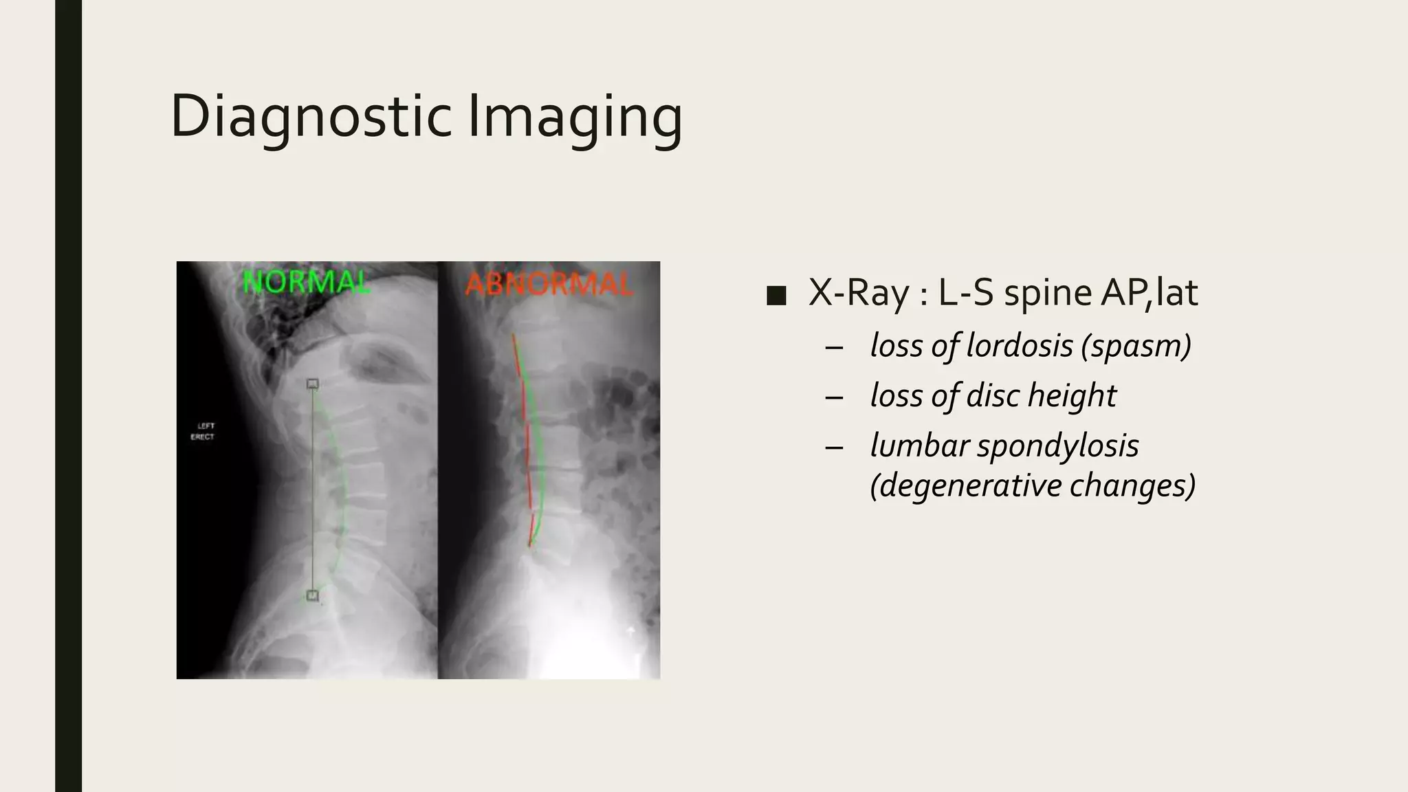 Herniated nucleus pulposus | PPTX