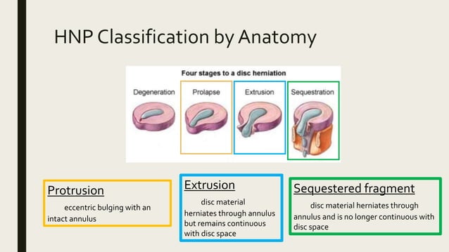 Herniated nucleus pulposus | PPT