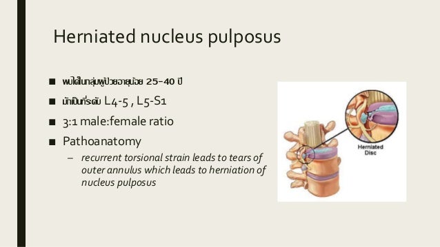 Herniated Nucleus Pulposus