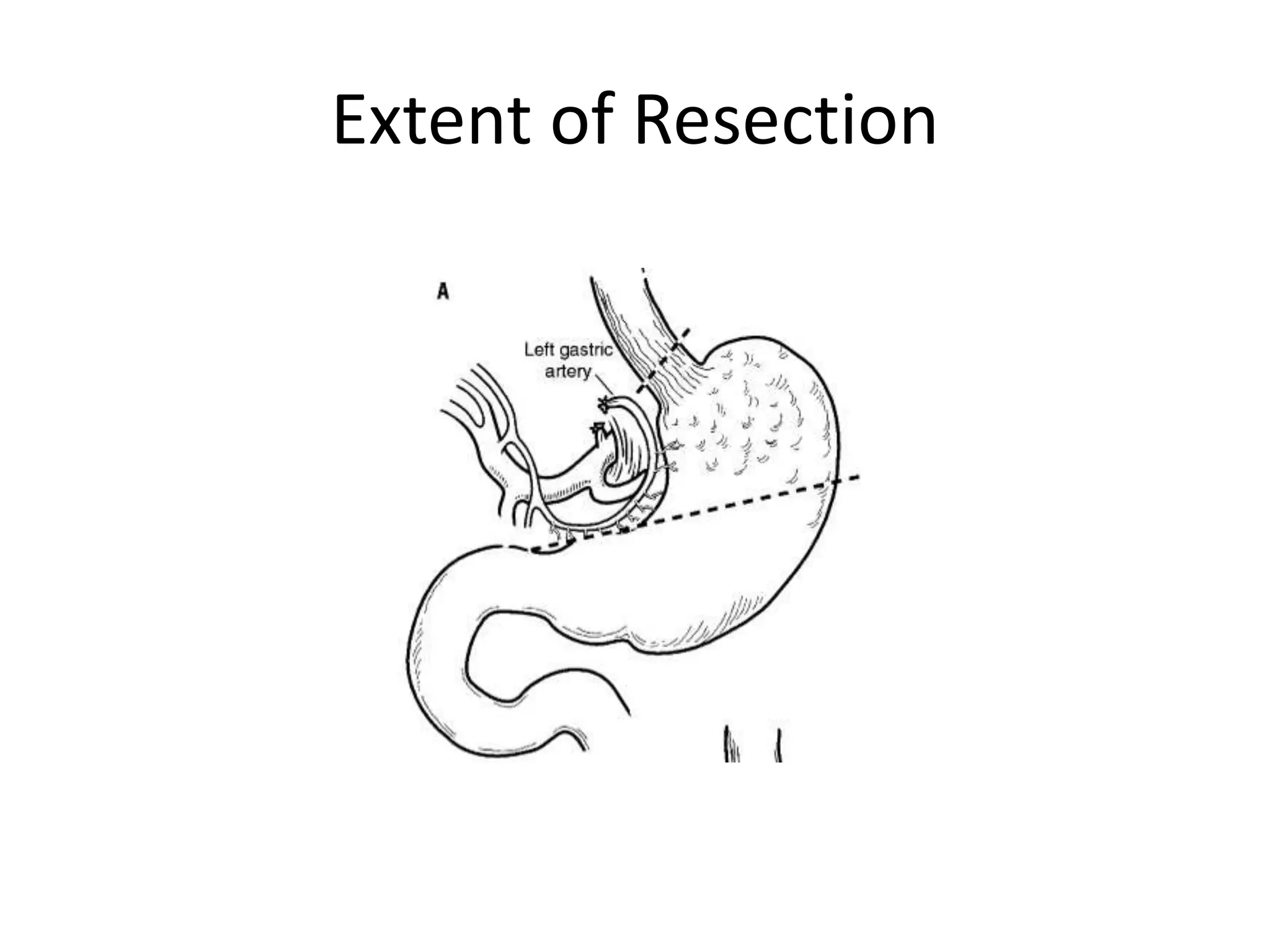 gastric resection, reconstruction and post gastrectomy syndromes | PPTX