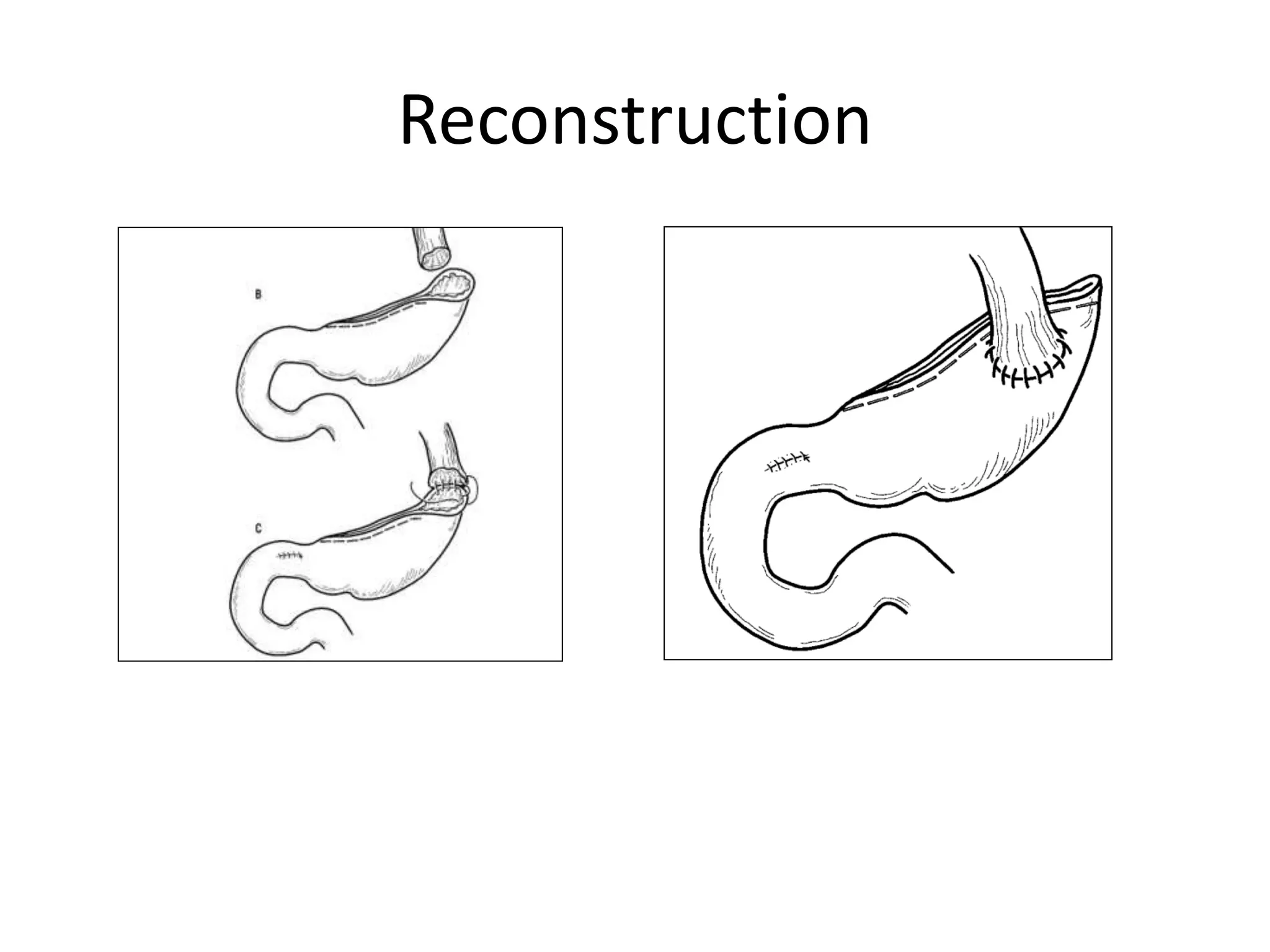 gastric resection, reconstruction and post gastrectomy syndromes | PPTX