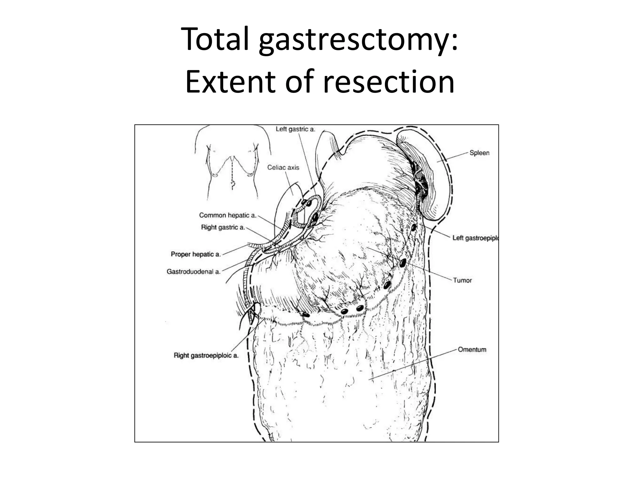 gastric resection, reconstruction and post gastrectomy syndromes | PPT