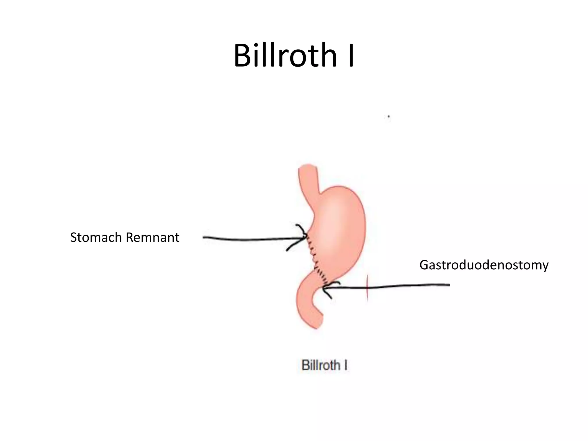 gastric resection, reconstruction and post gastrectomy syndromes | PPT