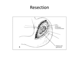 gastric resection, reconstruction and post gastrectomy syndromes | PPTX