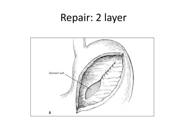 gastric resection, reconstruction and post gastrectomy syndromes