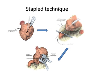 gastric resection, reconstruction and post gastrectomy syndromes | PPTX