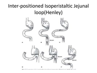 gastric resection, reconstruction and post gastrectomy syndromes | PPT