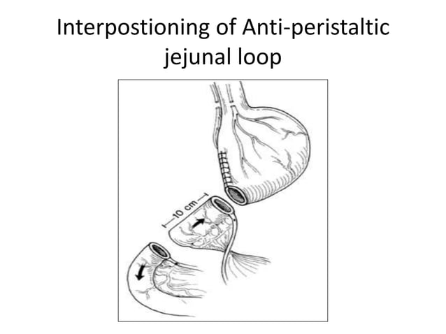 gastric resection, reconstruction and post gastrectomy syndromes
