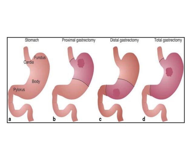 gastric resection, reconstruction and post gastrectomy syndromes