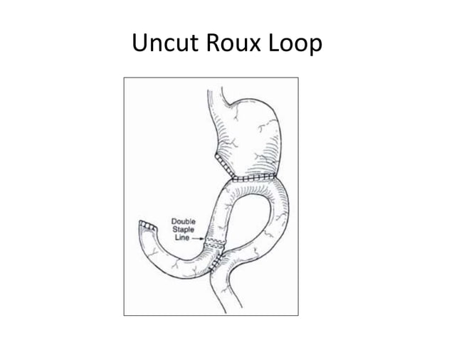 gastric resection, reconstruction and post gastrectomy syndromes