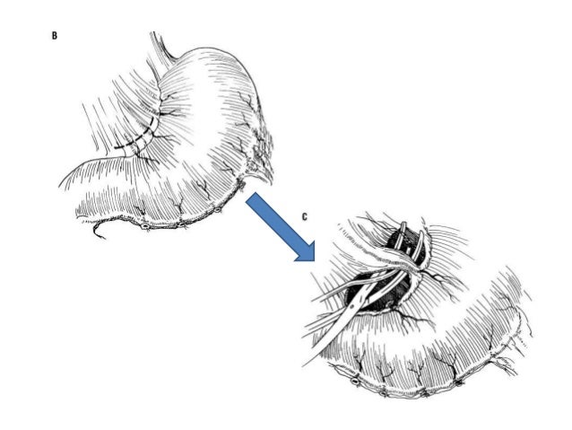 gastric resection, reconstruction and post gastrectomy syndromes