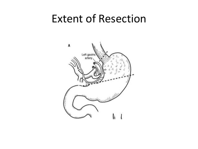 gastric resection, reconstruction and post gastrectomy syndromes