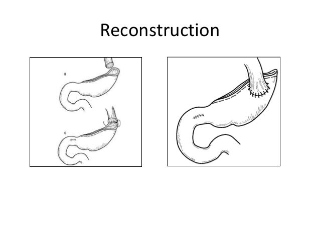 gastric resection, reconstruction and post gastrectomy syndromes