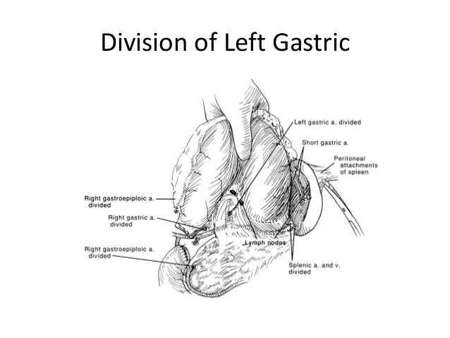 gastric resection, reconstruction and post gastrectomy syndromes