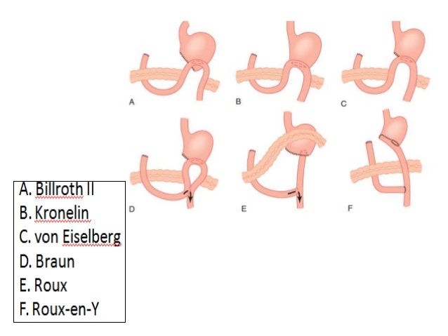 Gastric Bypass Billroth I Versus Billroth Ii Anatomy