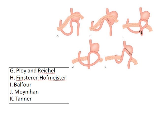 gastric resection, reconstruction and post gastrectomy syndromes