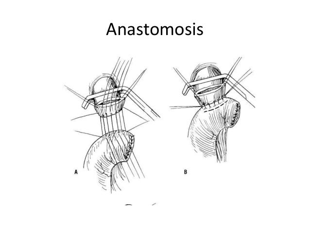 gastric resection, reconstruction and post gastrectomy syndromes