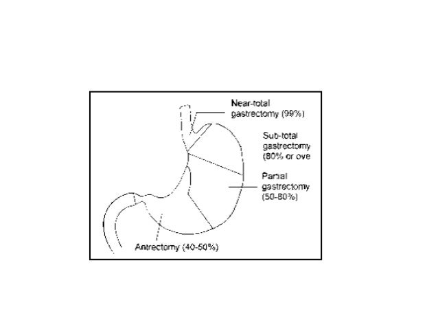 gastric resection, reconstruction and post gastrectomy syndromes