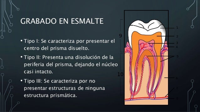 Grabado Ácido En Esmalte