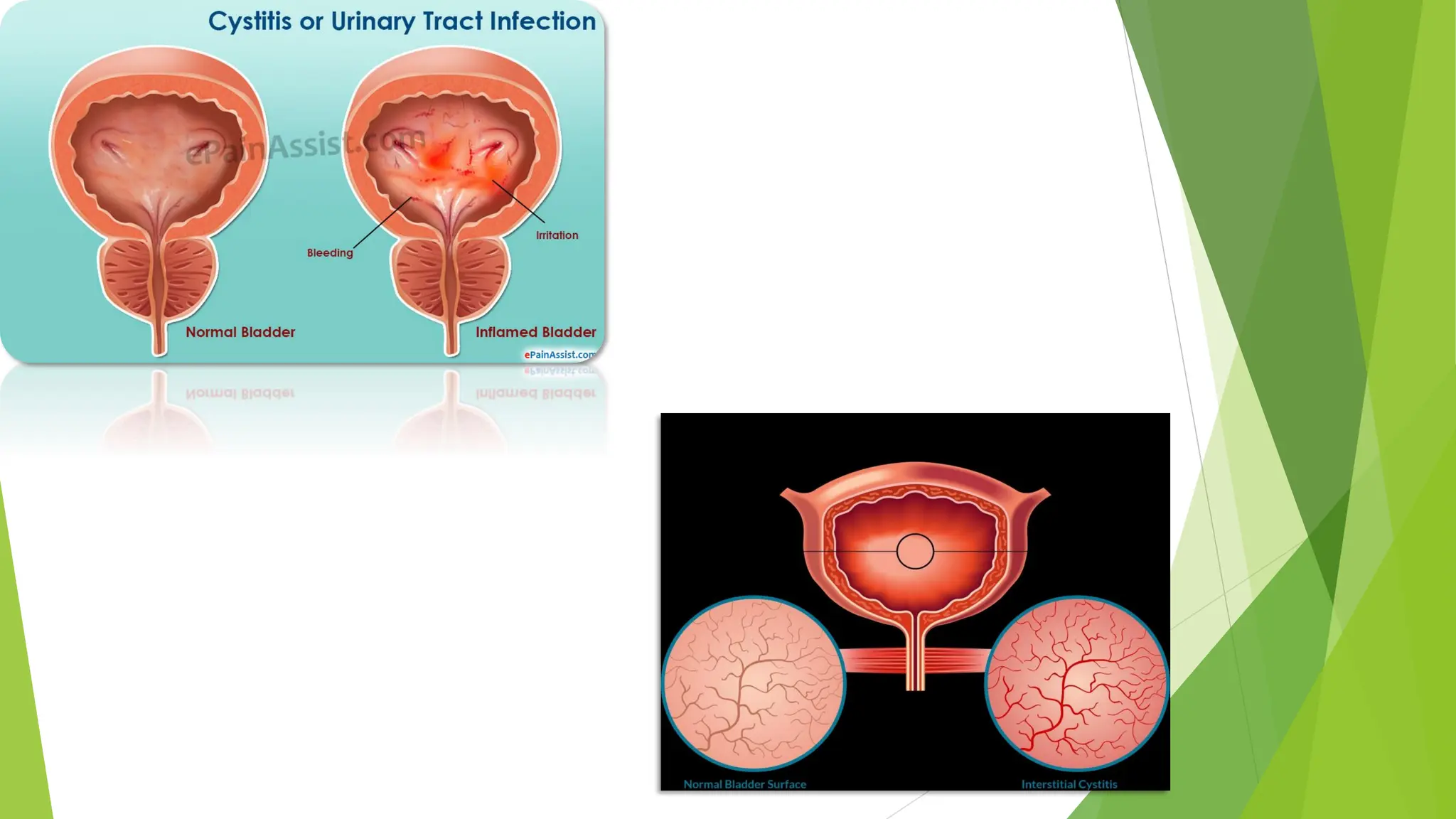 Grade 1 fatty liver and cystitis. Present by Dr. Nasir uddin | PPT