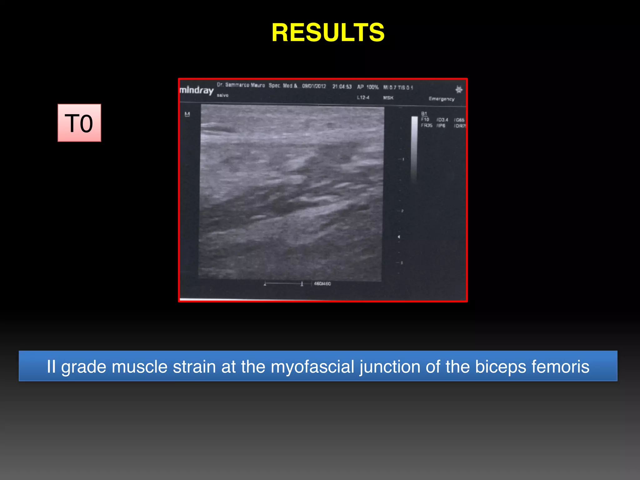 Grade 2 muscle injuries treatment with Cryo Mag | PDF