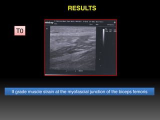 Grade 2 muscle injuries treatment with Cryo Mag | PPT