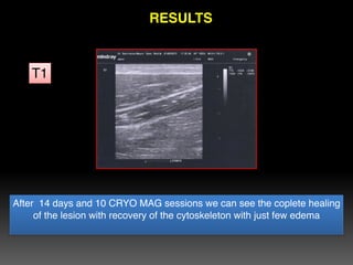 Grade 2 muscle injuries treatment with Cryo Mag | PPT