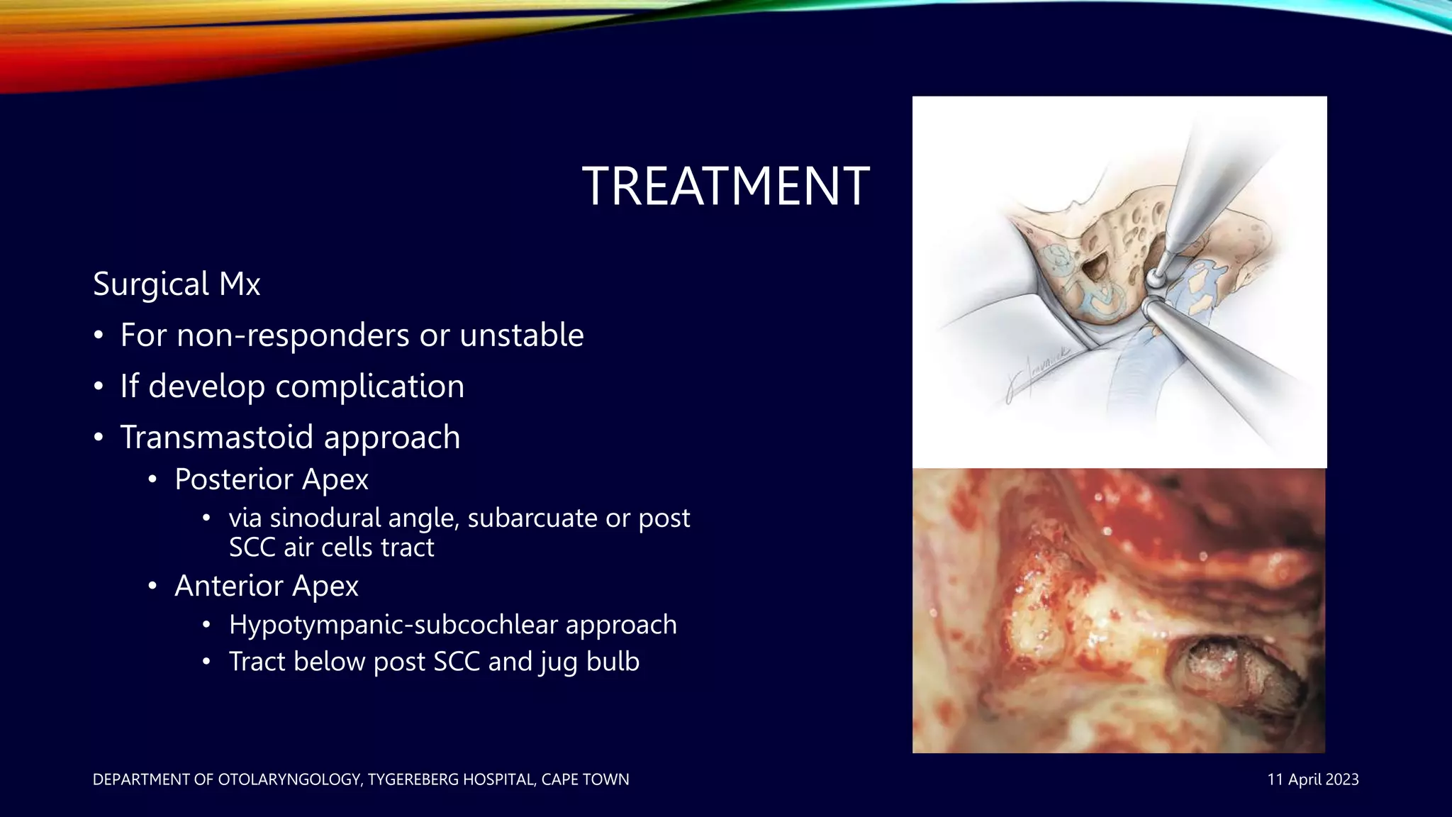 GRADENIGO SYNDROME | PPTX