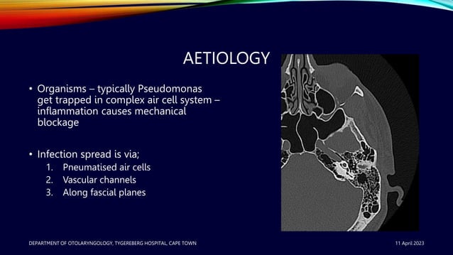 GRADENIGO SYNDROME | PPTX | Ear, Nose and Throat Conditions | Diseases ...