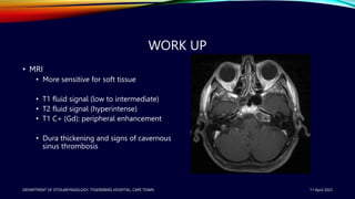 GRADENIGO SYNDROME | PPTX
